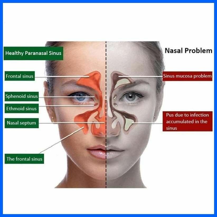 3 шт Спрей для носа китайский травяной 99, DINGJIAOSHOU - для лечения ринита, синусита, заложенности носа, 20 мл