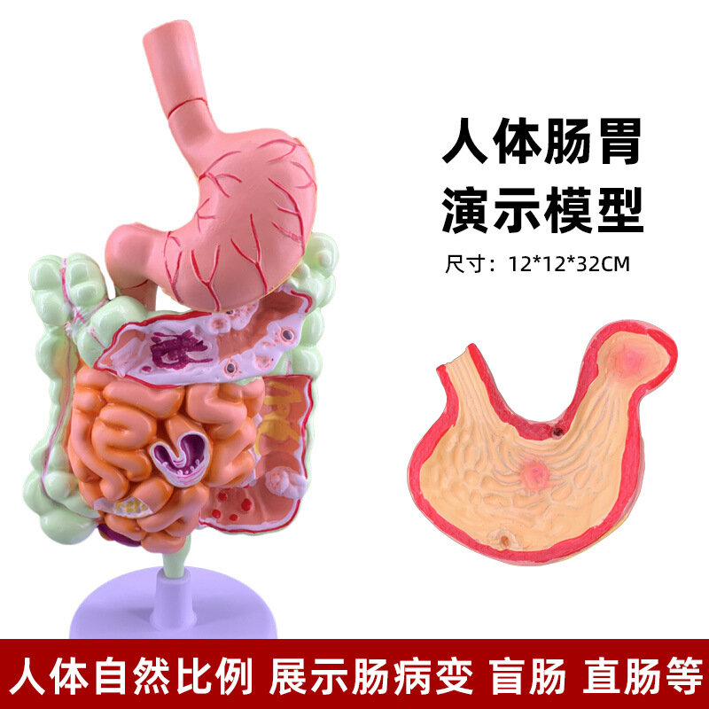 Модель патологии толстой кишки человека, модель анатомии кишечника и желудка, патологическая модель толстой кишки, кишечника, прямой кишки и двенадцатиперстной кишки