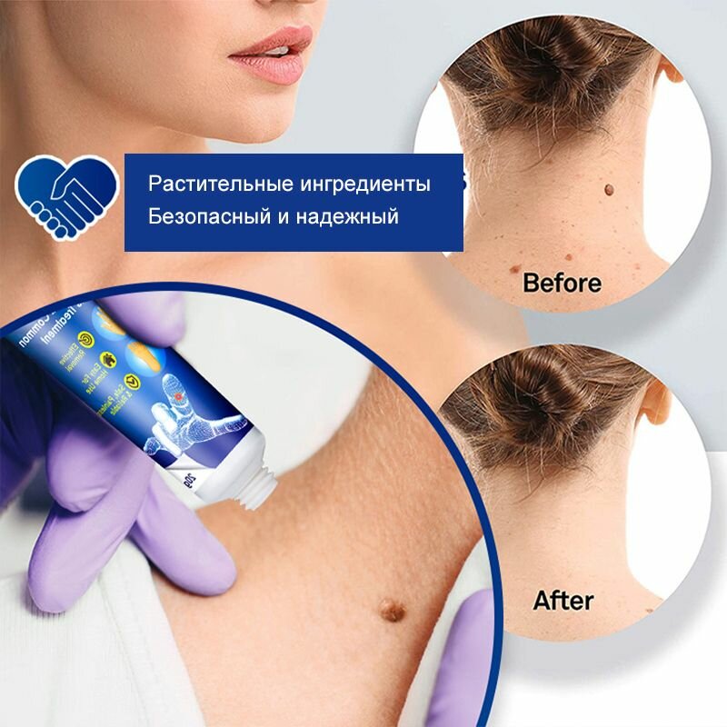 Крем-гель от бородавок, Средство от папиллом и бородавок, мазь для ухода за кожей 20 мл