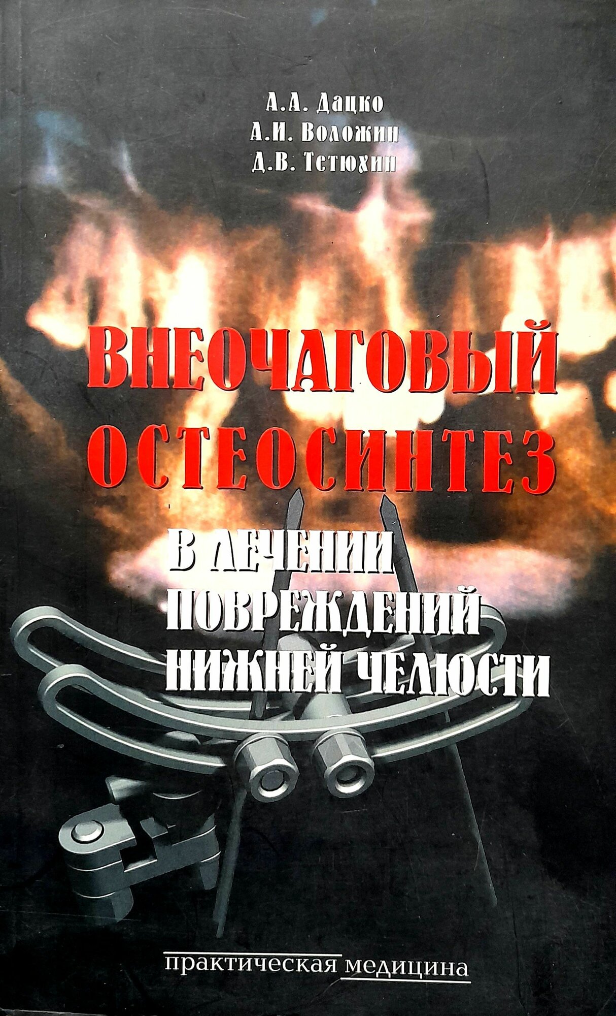 Внеочаговый остеосинтез в лечении повреждений нижней челюсти. Дацко.