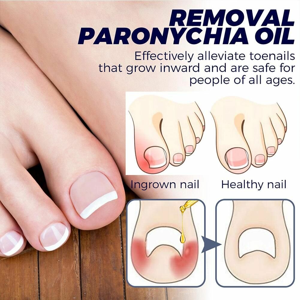 20г Вросшие ногти на ногах, удаляется масло паронихии, для ухода за ногтями на ногах