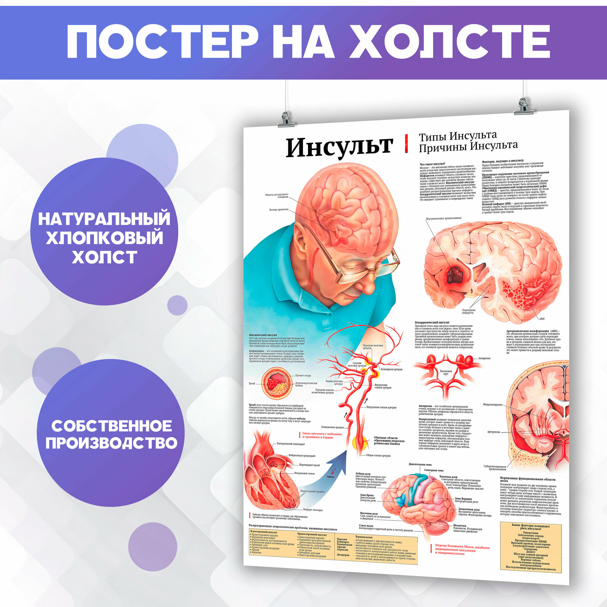 Постер на холсте Инсульт, анатомия, медицина, в больницу 60х80 см