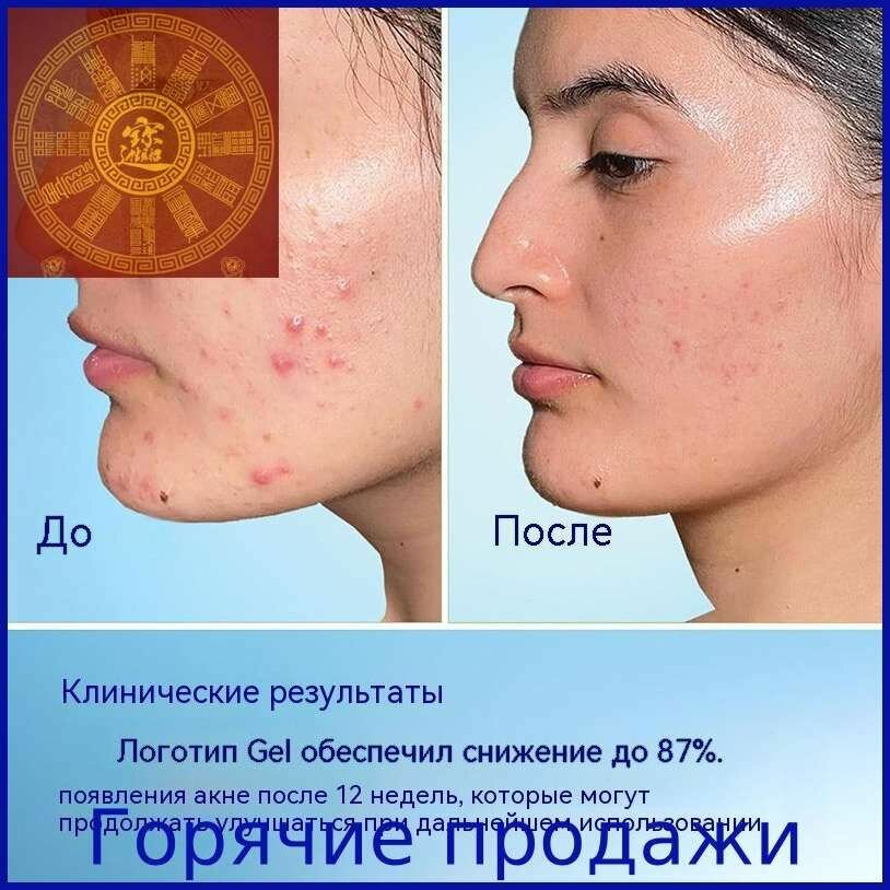 Differin, 0,1% Adapalen гель для ухода за кожей, для облегчения прыщей (лицевой витаминной кислоты), 15 г, Differin гель