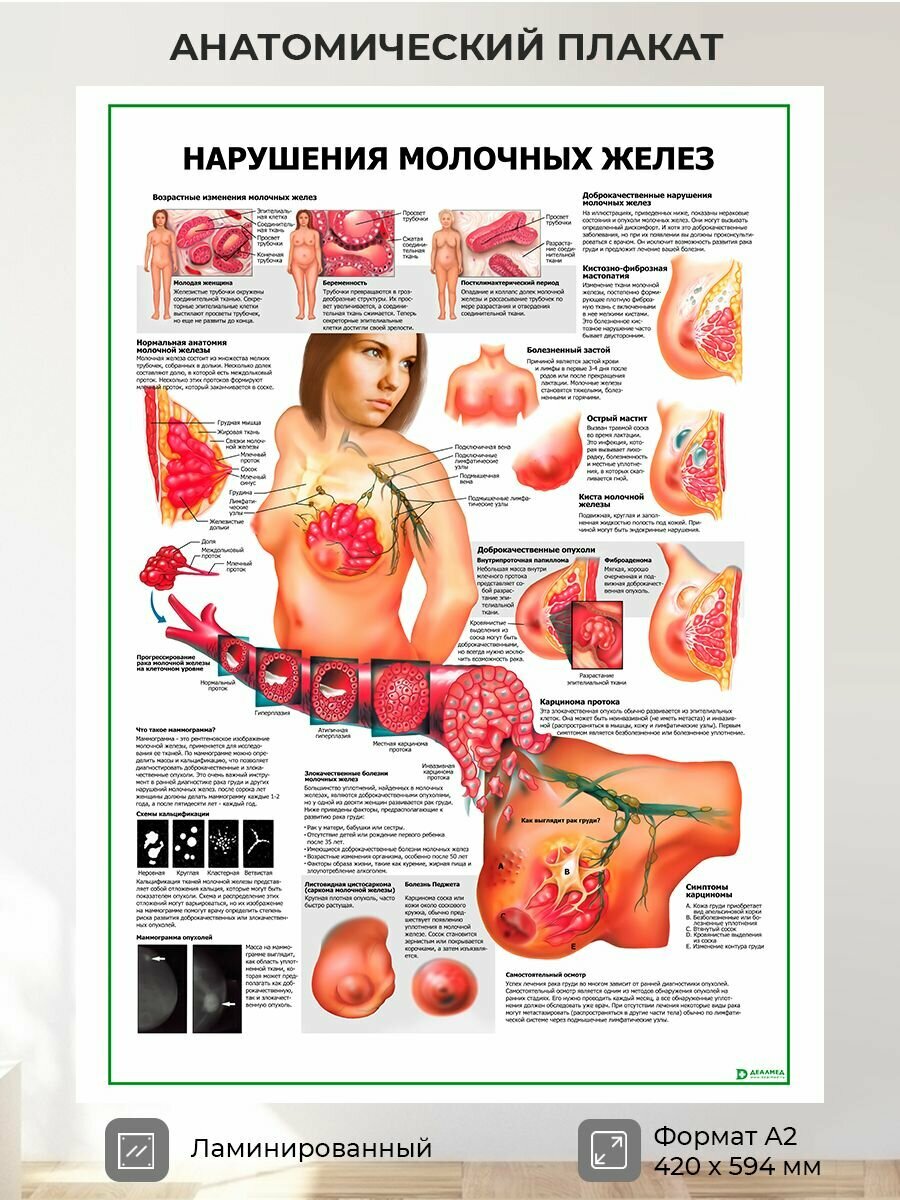 Обучающий медицинский плакат ламинированный формат А2 Нарушения молочных желез