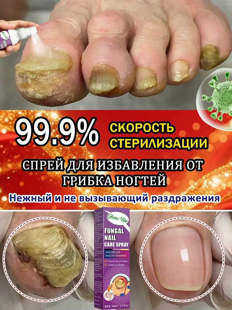 Растительная формула спрея от грибка-удаляет деформированные, утолщенные, пожелтевшие и другие поврежденные ногти, а также удаляет микробы с корнем, 30 мл