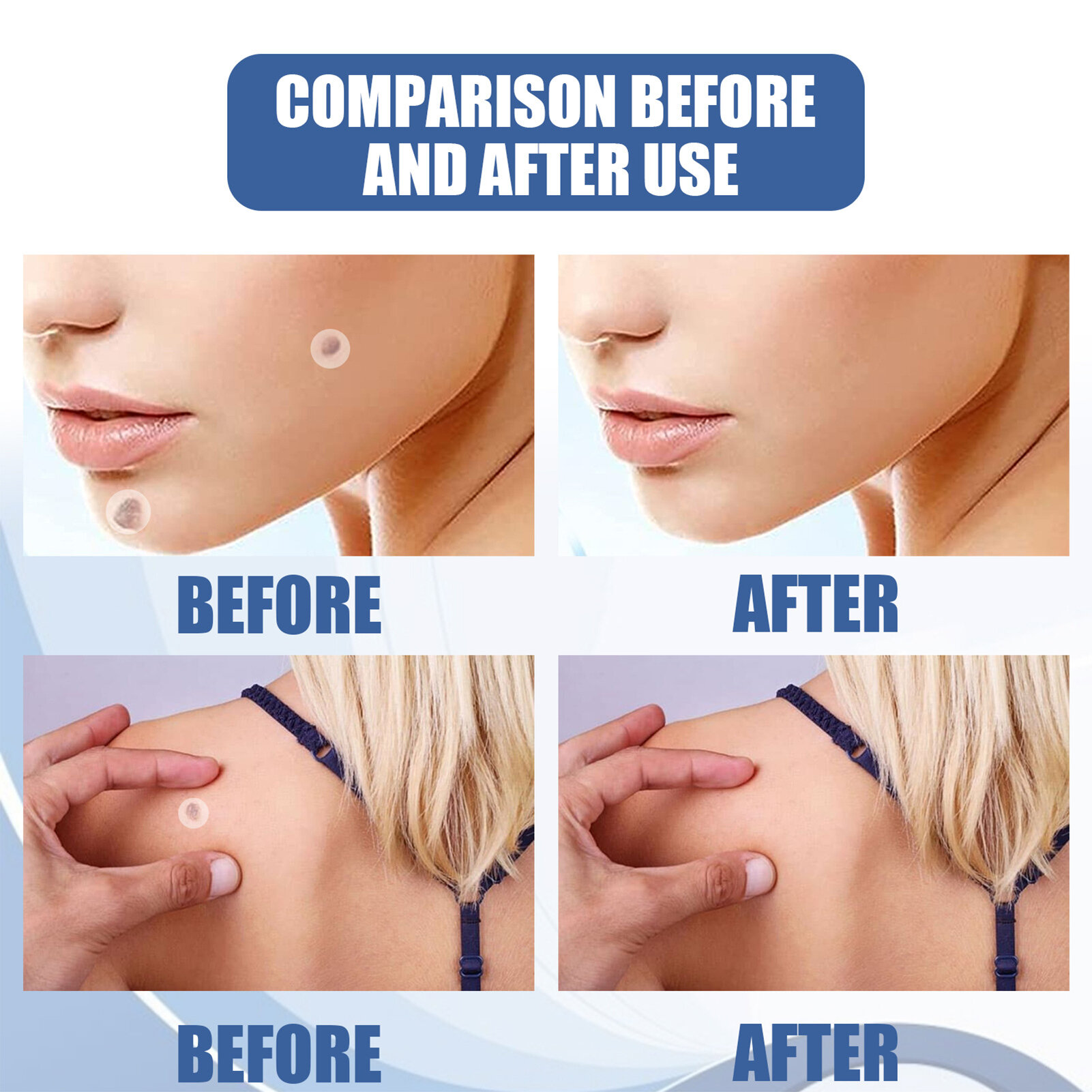 EELHOE 144 шт. пластыри для удаления родинок и бородавок натуральные ингредиенты смягчают кератин безболезненное удаление