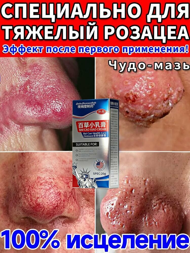 Крем от розацеаисцеление красный нос и прыщи