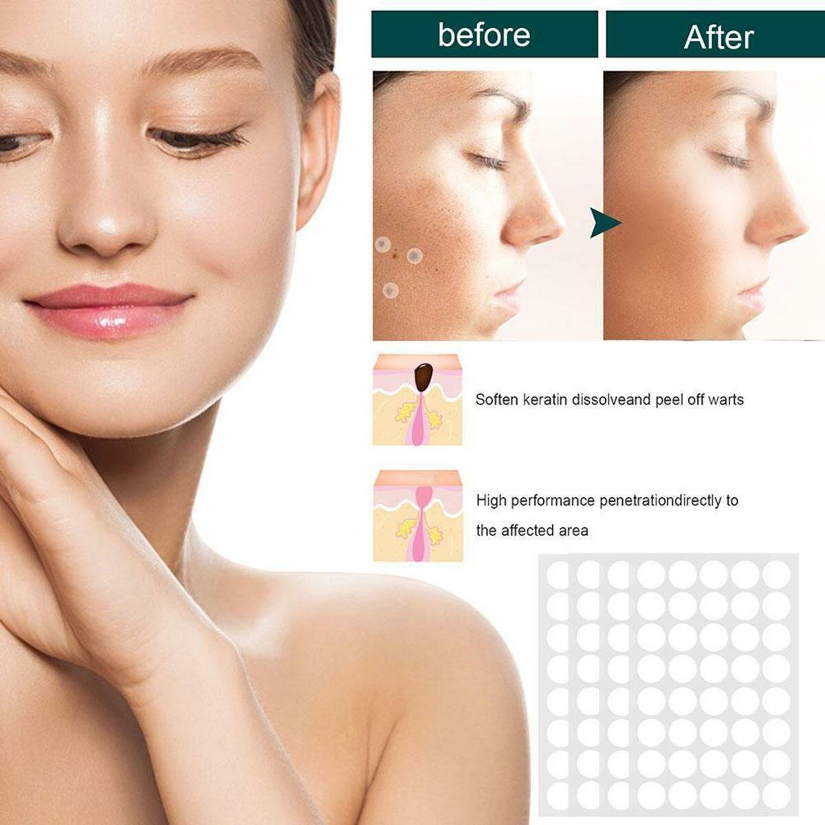 120 шт, пластырь для удаления бородавок, многофункциональная невидимая наклейка для удаления родинок, прыщей, противовоспалительные, заживляющие раны, наклейки для ухода за кожей