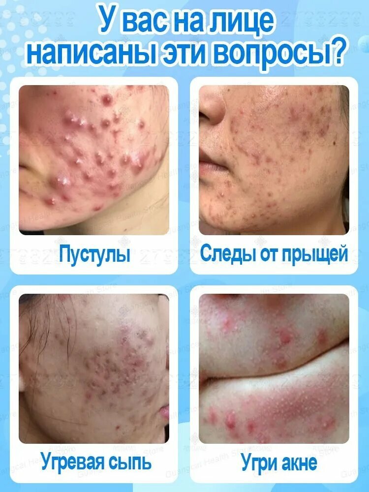 Лазерная указка от прыщей, Подходит для лечения угревой сыпи на лице и теле, Лечение акне, быстрый, Избавиться от прыщей, от черных точек и угрей, безболезненный, Пигментация