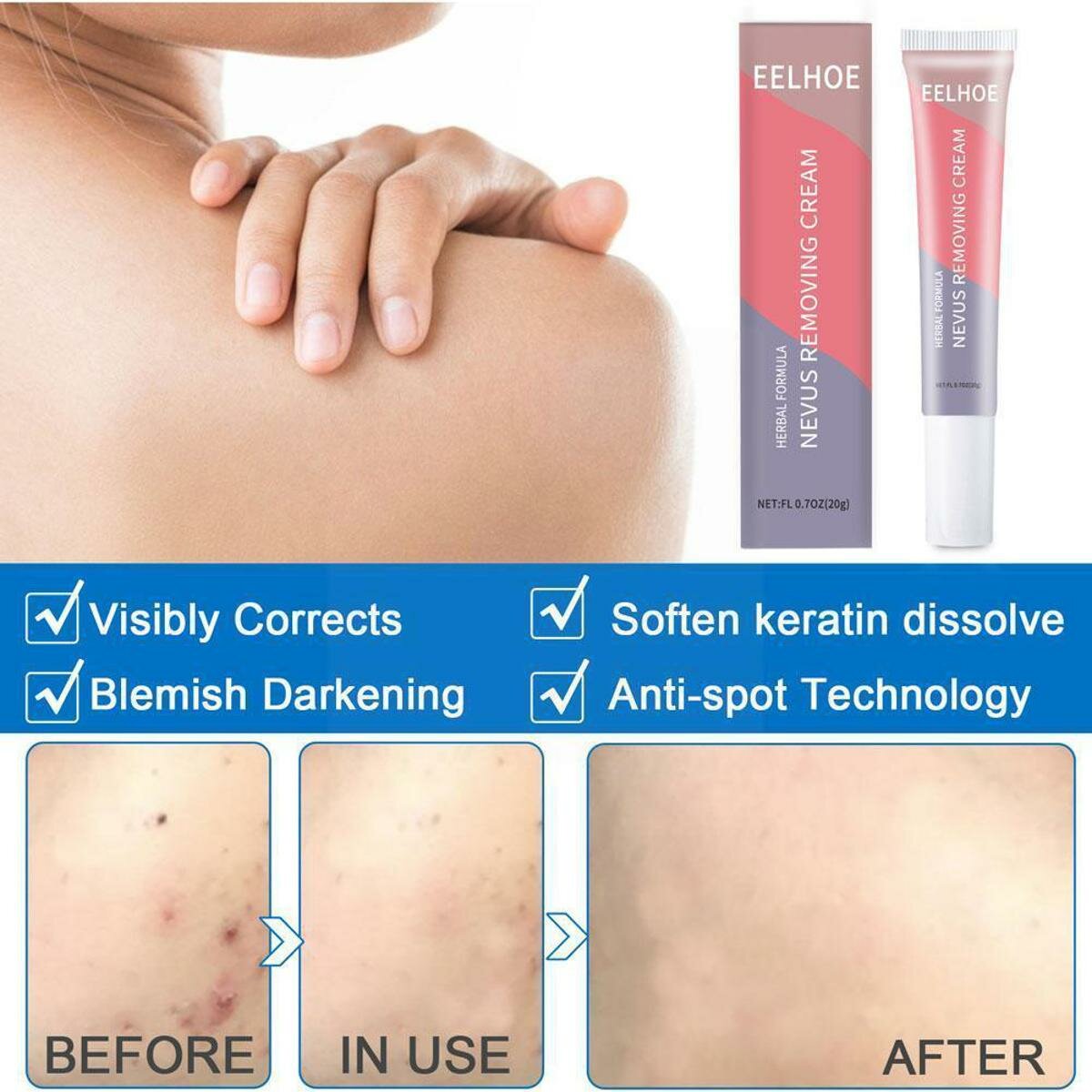 1 * Крем для точек красоты, мазь от родинок, мазь для удаления родинок, восстанавливающая мазь без шрамов от прыщей, мазь со следами прыщей на лице L0J4