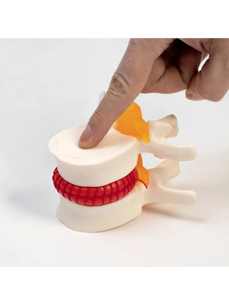 Анатомический макет межпозвоночного диска