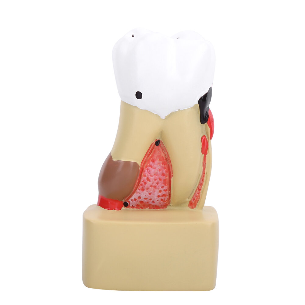 1 шт. Учебная модель зуба для комплексного изучения патологических заболеваний зубов, включая кариес.