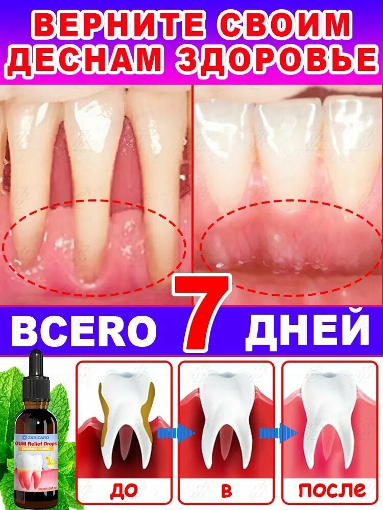 Используется для лечения пародонтита, стоматита, снятия чувствительности и отека десен, восстановления, профилактики и укрепления поврежденных десен, Гигиена полости рта.90 мл.