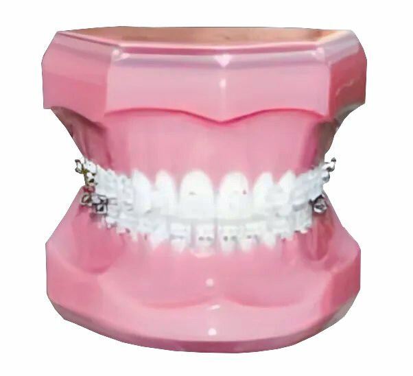 Брекет-система керамическая Kronen Glanz, лигатурные с крючками на 3.4.5 и щёчными трубками на 6 и 7 зубы. Пропись Roth 022. Верхняя челюсть. Набор 10 шт.(Германия)