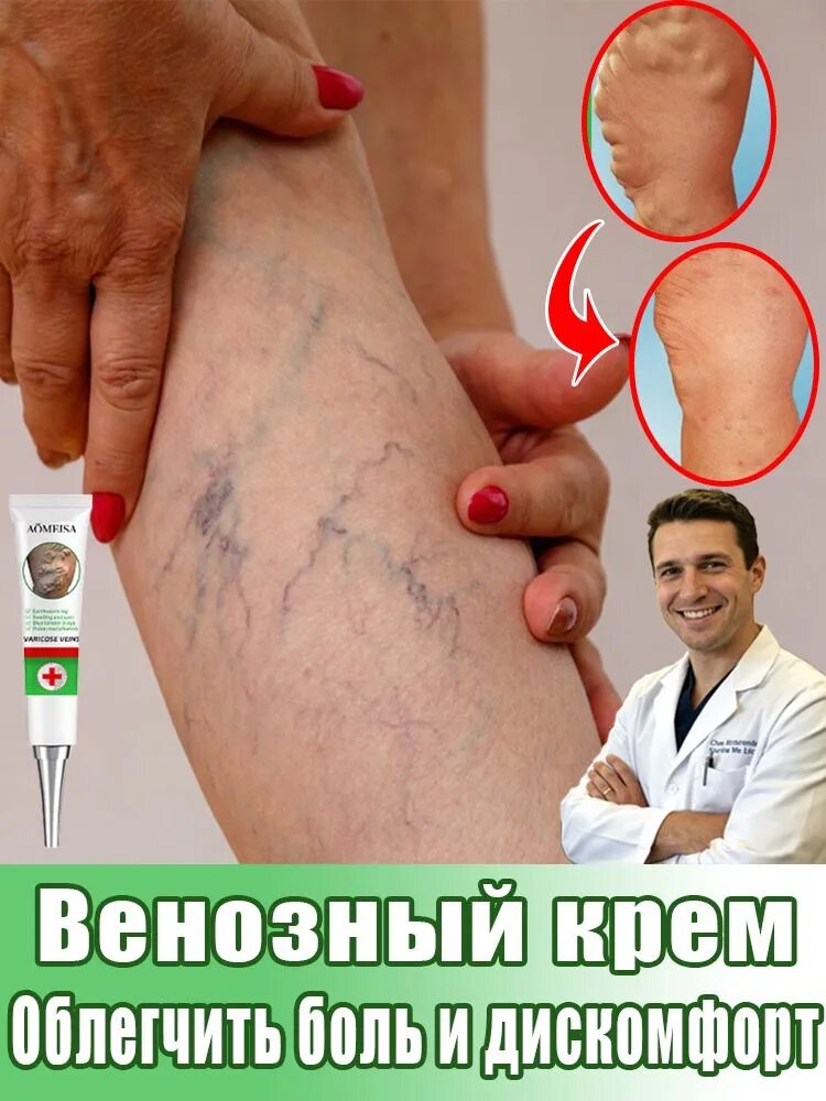 Мазь от варикозного расширения вен, подходит для лечения расширенных кровеносных сосудов, отеков ног, снятия боли и усталости, а также уменьшения зуда. 30 мл