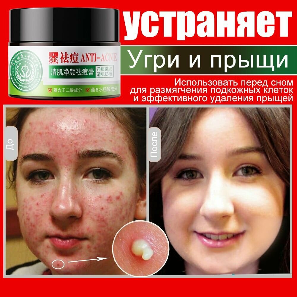 Цинковый крем, Гель от прыщей, прыщей, акне, постакне для наружного применения. Мазь цинковая от прыщей увлажняющая, точечное средство для подростков и взрослых 30 г.