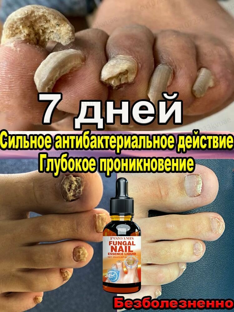 Используется для лечения грибка ногтей на руках и ногах. Лечите грибковые инфекции, укрепляйте и восстанавливайте ногти и роговой слой кожи, а также устраняйте грибок ногтей на ногах.10 мл