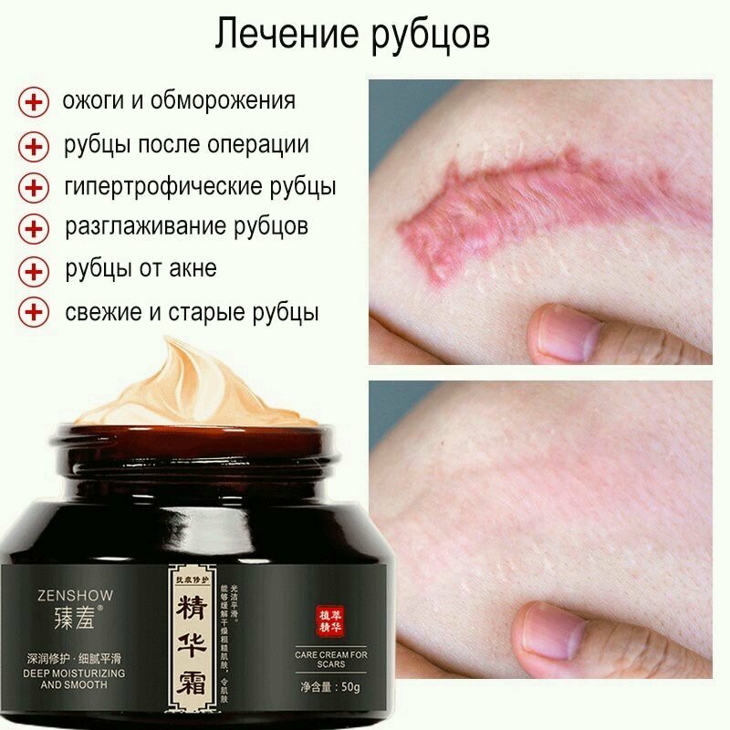 Средство от растяжек