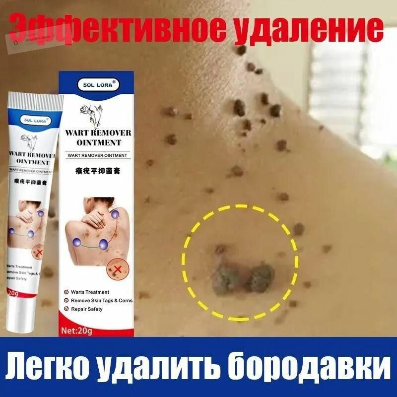 Мазь от бородавок, против генитальных бородавок, папиллом, ороговевшей кожи, мазь от прыщей, 20 гПечатная версия