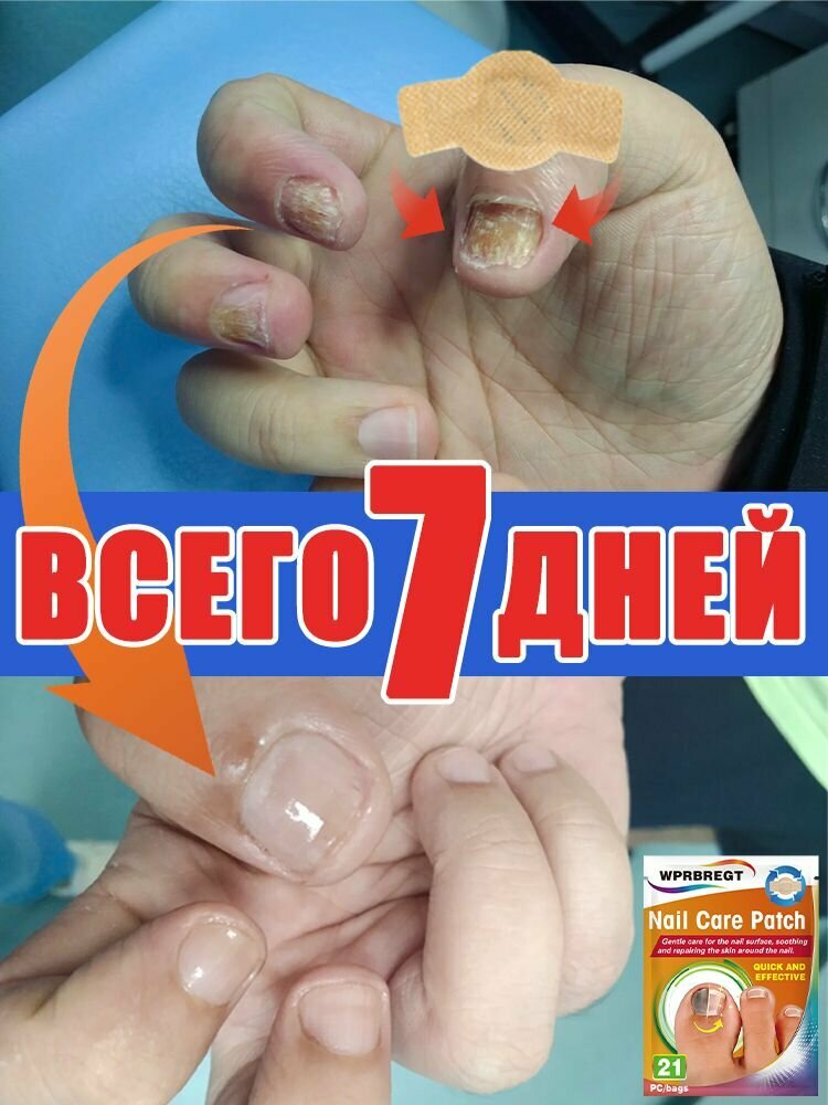 Пластыри для лечения грибка ногтей быстро лечат онихомикоз, подавляют рост грибка и устраняют такие проблемы, как расщепление и растрескивание ногтей.105 шт