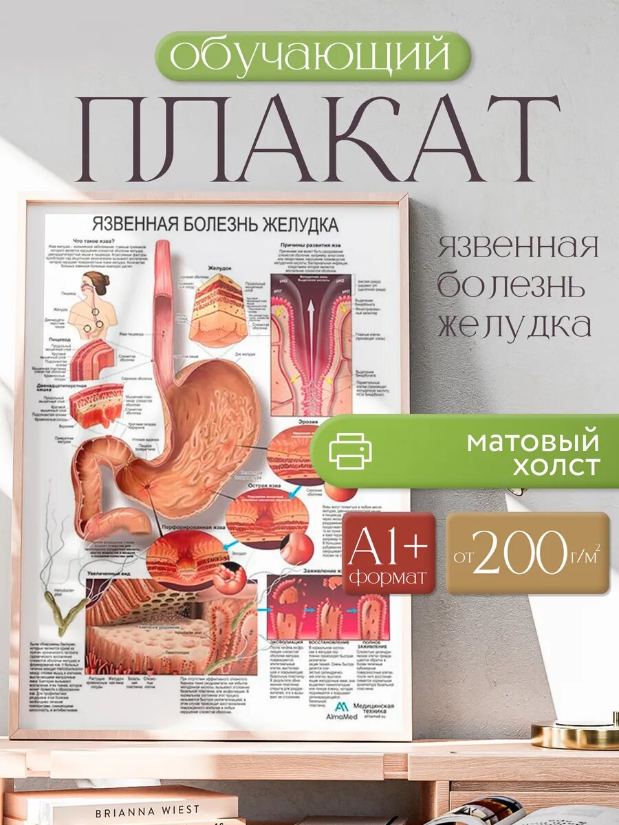 Обучающий плакат "Язвенная болезнь желудка (анатомия человека)", размер А1+, матовый холст от 200г/м2