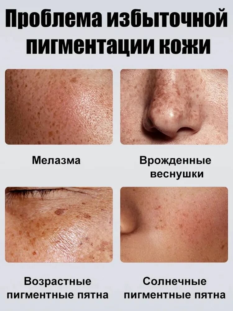 Отбеливающий крем от веснушек и солнечных пятен, подходит для удаления и исчезновения желтых пятен и старческих пятен, 20 г. от старческих пятен от желтых пятен