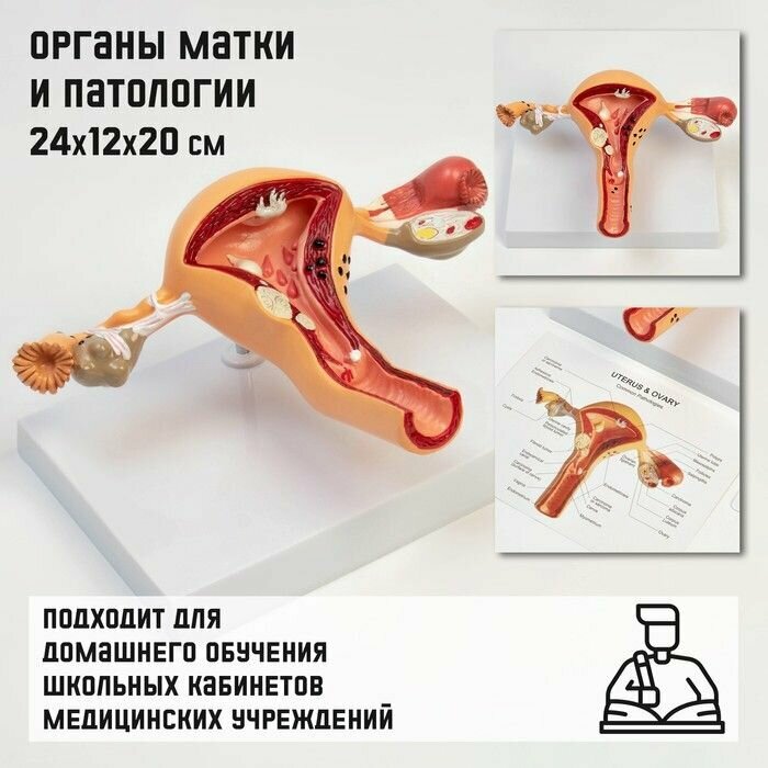 Анатомическая модель КНР "Макет матки с патологиями", 24х12х20 см