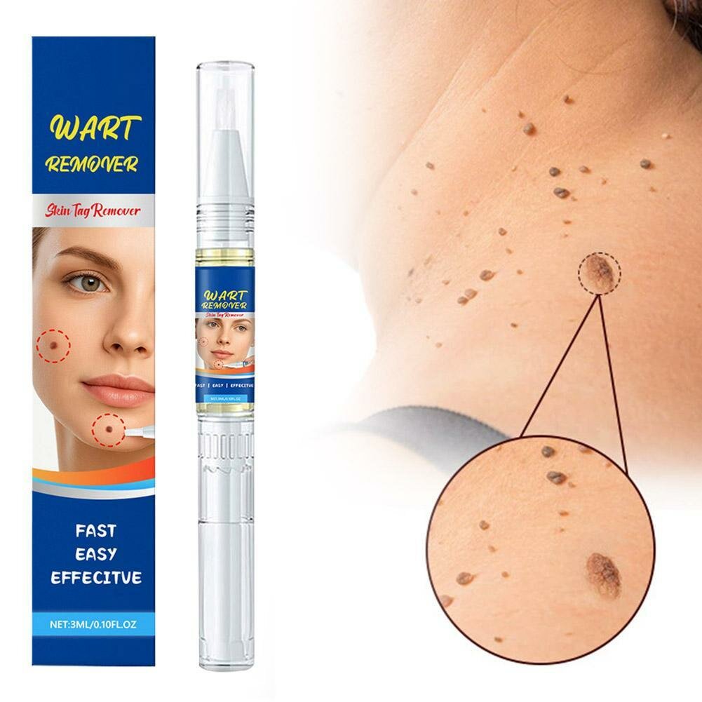 Эссенция для удаления бородавок, папиллом и родинок, безболезненно, без шрамов побочных эффектов / 3 мл, Быстрое удаление бородавок Нежный от средство