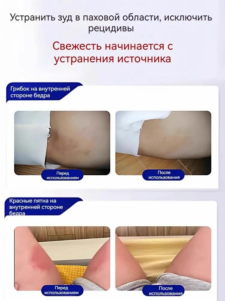 Паховый грибок противогрибковая мазь для кожи
