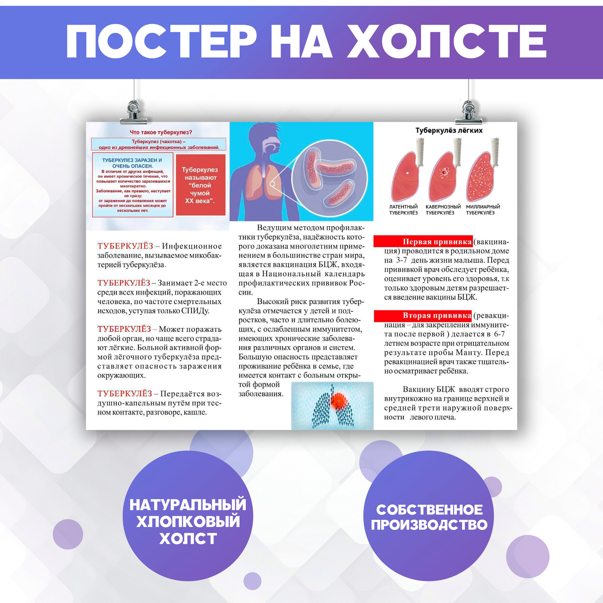 Постер на холсте туберкулез больницы медицина (35) 30х40 см