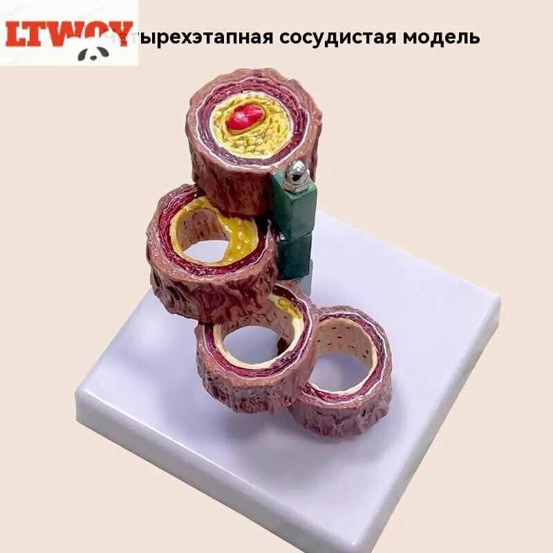 Анатомическая модель атеросклероза сосуда