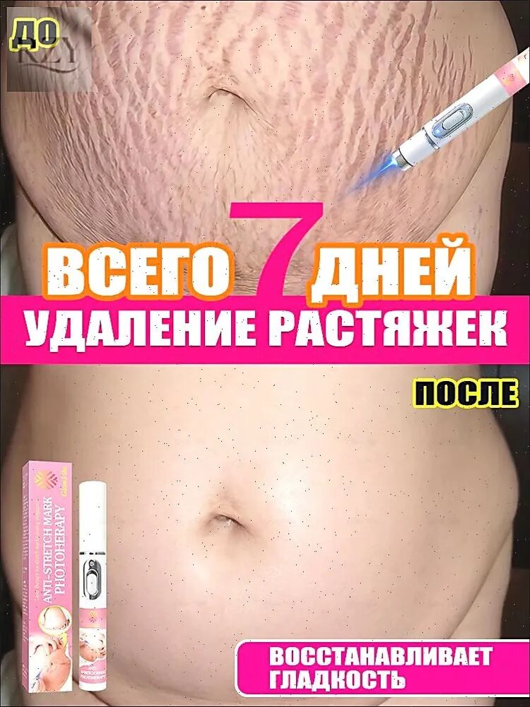 Бытовая лазерная указка от растяжек, нет необходимости обращаться в больницу, чтобы легко избавиться от растяжек,1pc