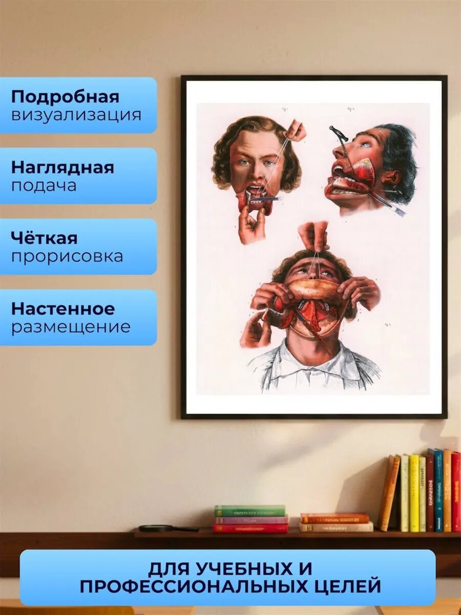 Постер медицинский, резекция, пластическая хирургия, пластика, А3 анатомия, хирургия