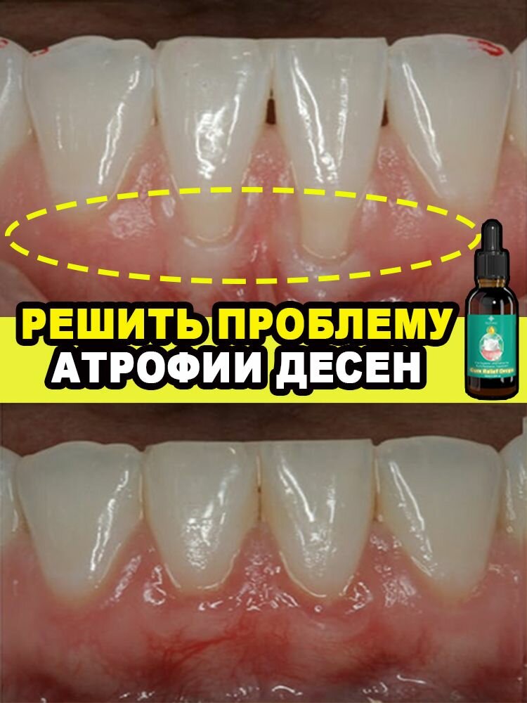 Используется для лечения пародонтита, стоматита, снятия чувствительности и отека десен, восстановления, профилактики и укрепления поврежденных десен, Гигиена полости рта.30 мл.