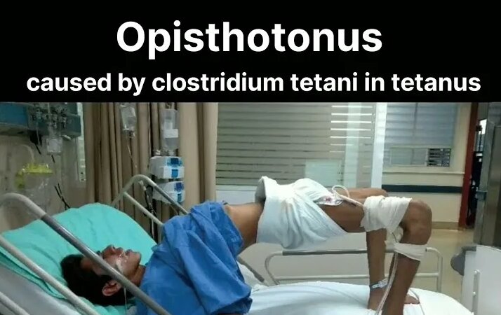 Opisthotonus caused by clostridium tetani in tetanus#doctor#viral # ...