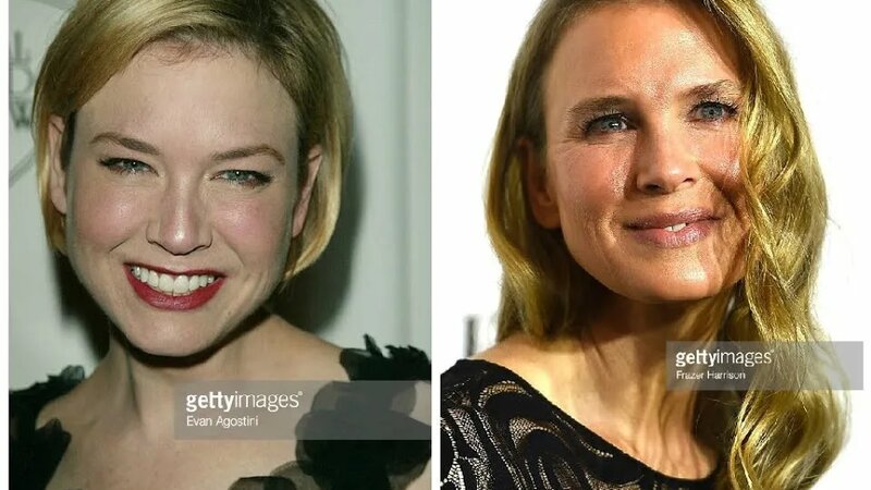 Renée Zellweger Plastic Surgery Before and After Photos - Смотреть ...