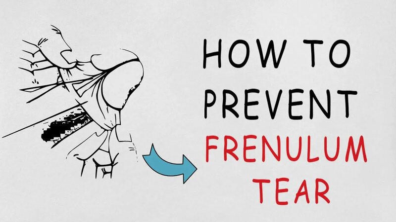 Frenulum Tear: What to Do & How to Speed Up Healing - Смотреть онлайн в ...