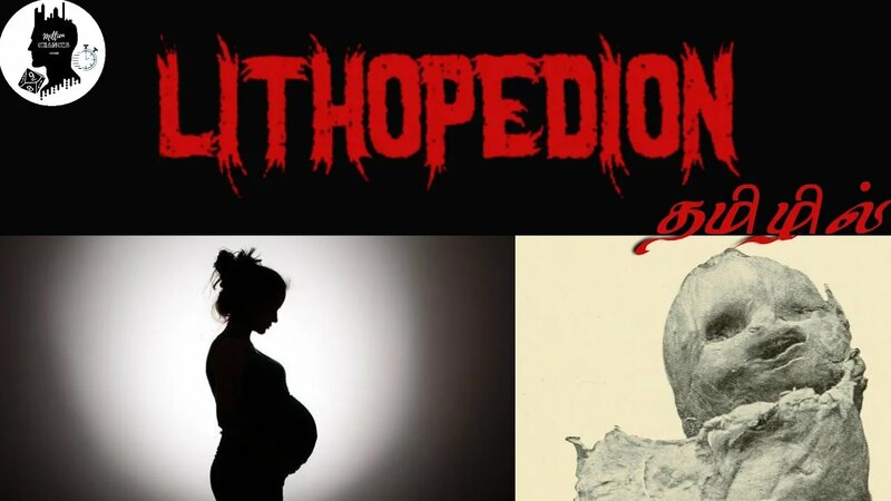 Lithopedion - Stone BABY (தமிழ்)| #Millionchances - Смотреть онлайн в ...