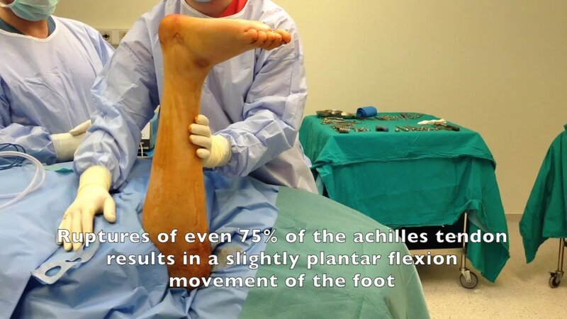 Achilles Tendon Rupture Tests: Thompson Test and Matles Test - Yandex ...