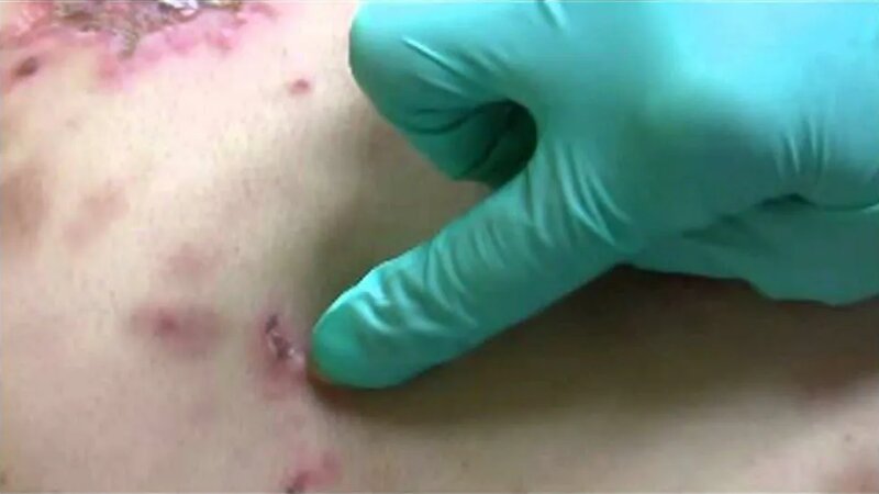 Nikolsky Sign Pemphigus Vulgaris - Yandex Video aramada çevrimiçi izle