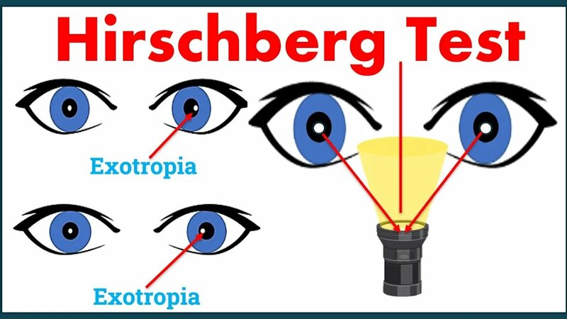 Hirschberg Corneal Reflex Test - A complete Tutorial. - Смотреть онлайн ...
