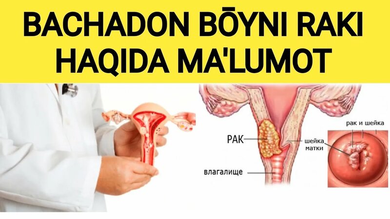 Bachadon bo'Yni saratoni haqida ma'lumot. бачадон буйни раки хақида ...