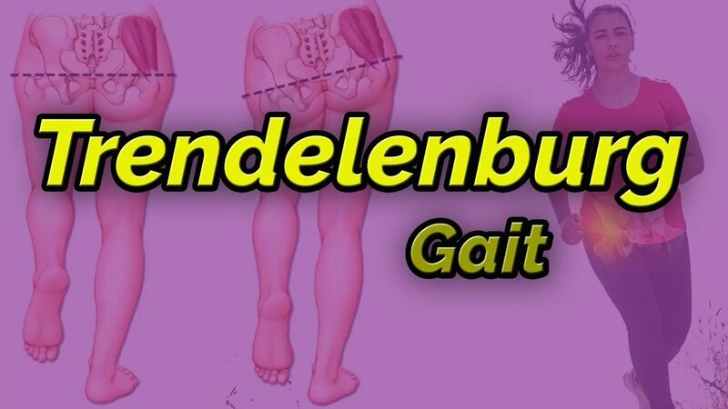 Trendelenburg`s Gait - Yandex Video aramada çevrimiçi izle