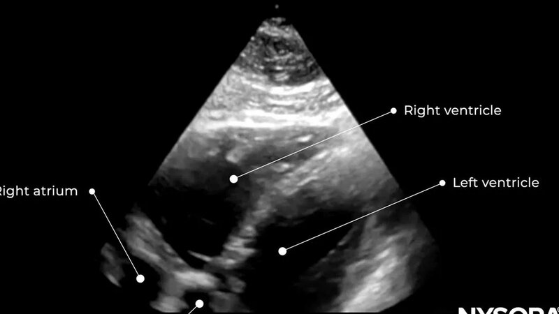 Central venous catheter position - Rapid atrial swirl sign (RASS ...