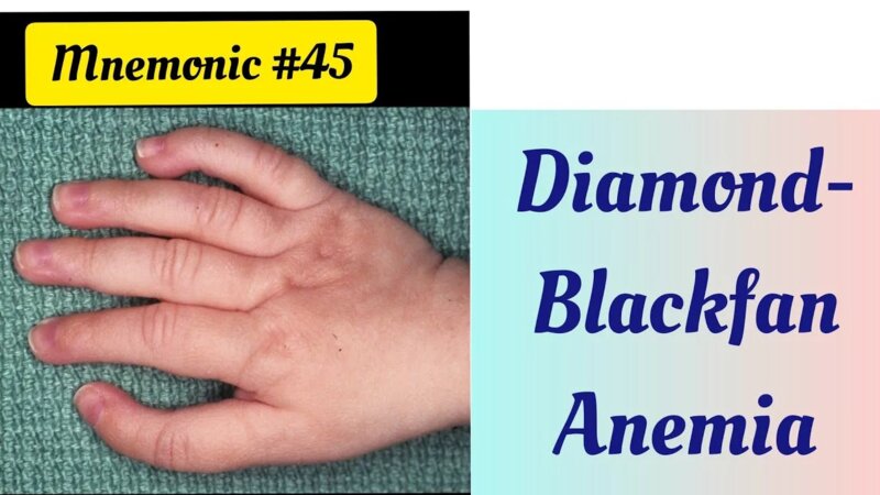 Diamond Blackfan Anemia presentations Mnemonic - Yandex Video aramada ...
