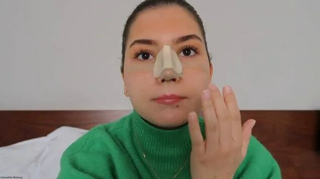 Nose Job/ Rhinoplasty in Istanbul Part 2 | Surgery day & Cast off day ...