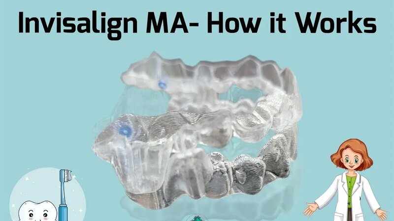 How Invisalign with MA Works - Yandex Video aramada çevrimiçi izle