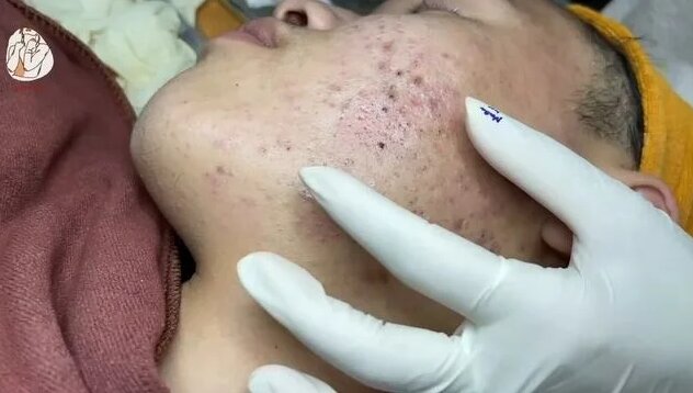 Remove Big Acne On Middle-Aged Men's Back - Смотреть онлайн в поиске ...