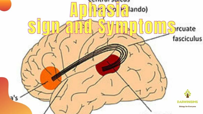 Aphasia signs and symptoms , What is aphasia - Смотреть онлайн в поиске ...