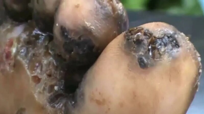 How to remove a jigger from the foot - วิธีการลบ Jigger จาก เท้า P1 ...